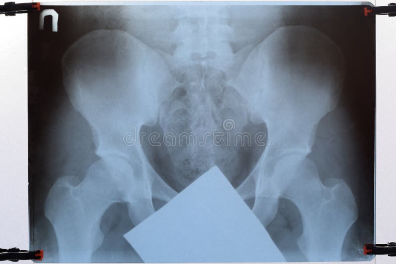 X-ray of the Pelvis and Sacrum. X-ray Stock Image - Image of arthritis ...