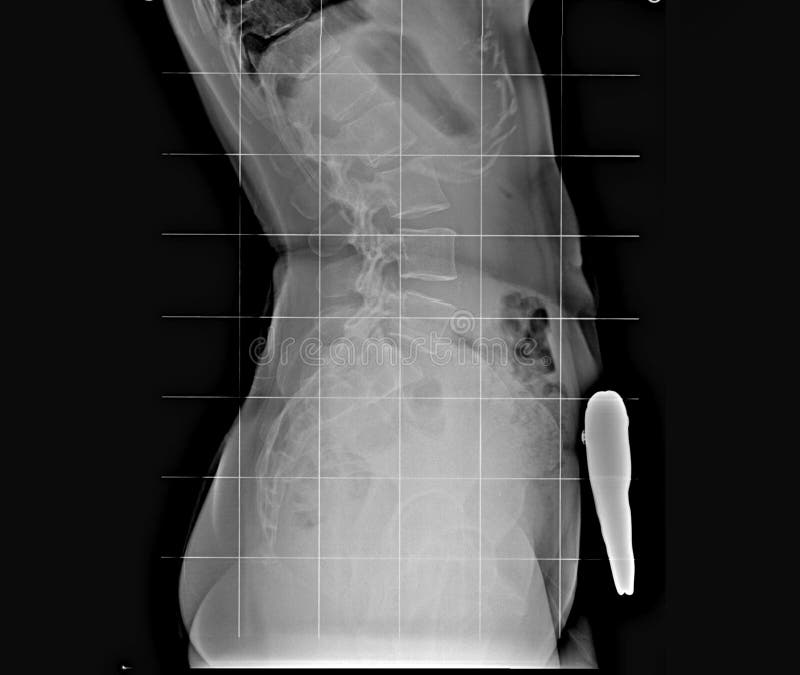X-ray of the Pelvis and Spinal Column, Front View Stock Image - Image ...