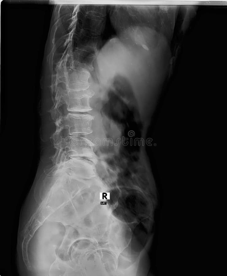 A Black and White X-ray of a Person S Back and Pelvis. the Image is of ...
