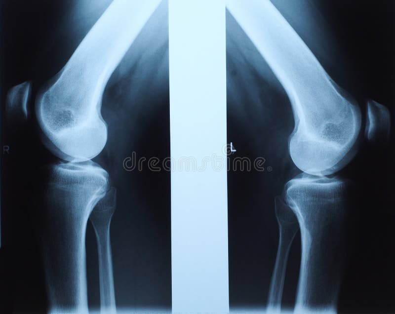 X ray photo of human knee stock image. Image of medicine - 3551863