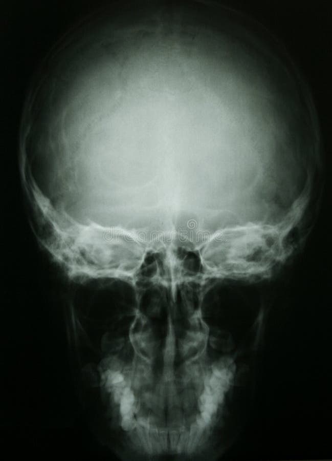 X-ray Photo of a Human Skull Stock Photo - Image of frontal, brain ...