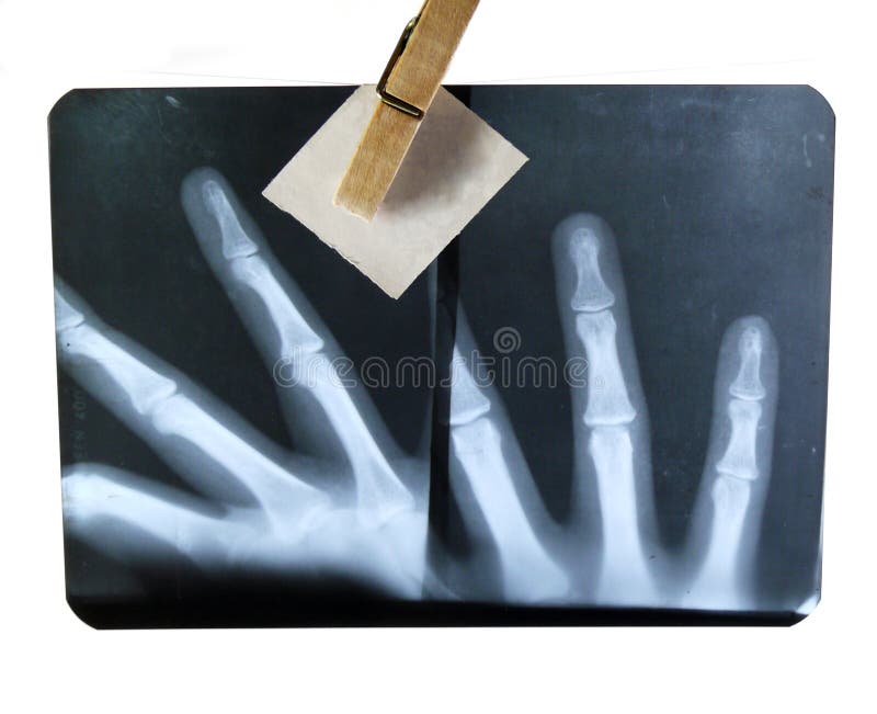 Ray Arthrogram Stock Photos - Free & Royalty-Free Stock Photos from ...