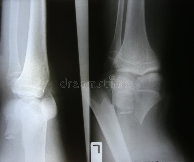 X-ray Photos of Bone Fracture Patients Stock Photo - Image of accident ...