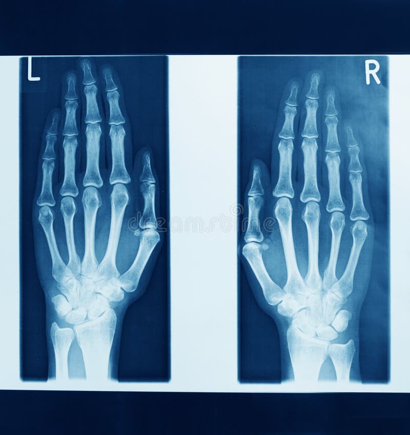 Normal Left Hand X Ray