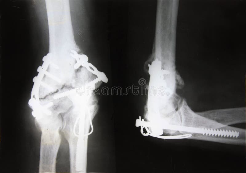 Elbow X Ray Fracture