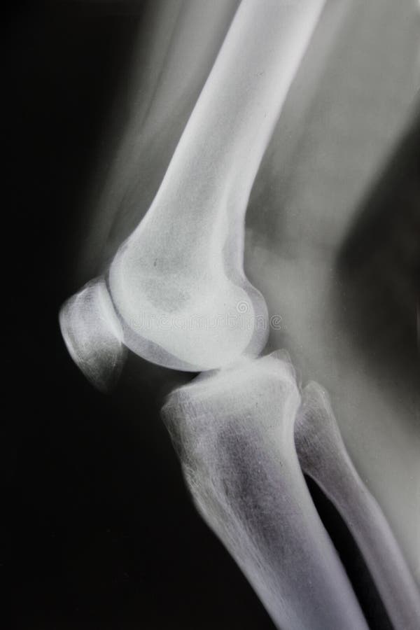 Normal Knee xray stock photo. Image of radiology, hospital - 14088732
