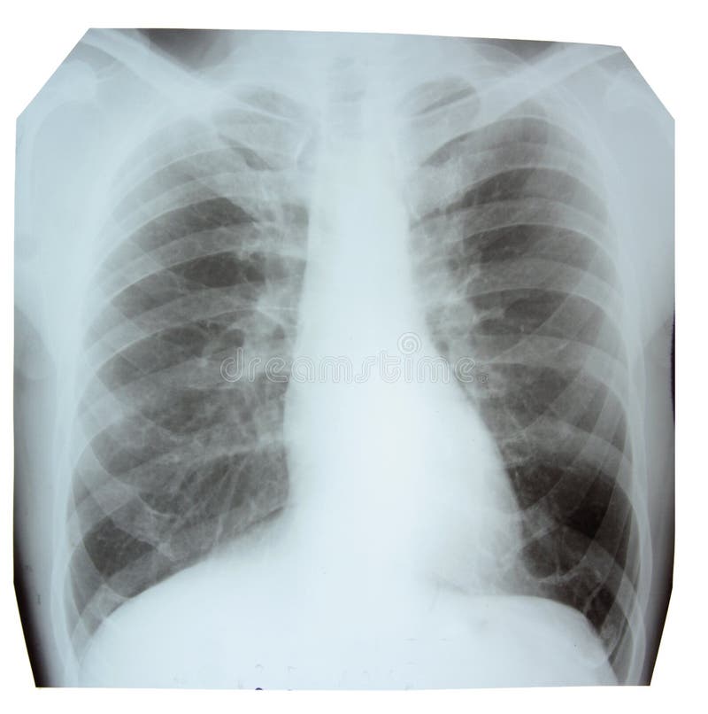 Normal X - Ray Radiography of Chest, Lung and Hear Stock Photo - Image ...