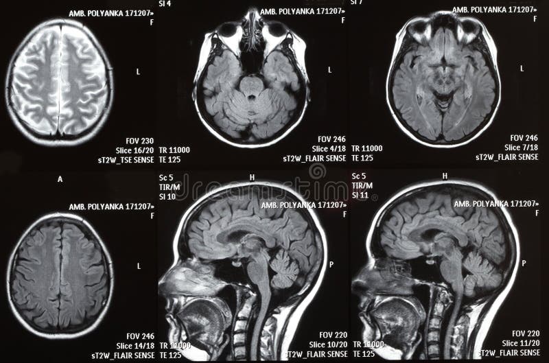 X-ray picture of a brain stock photo. Image of medical - 4949666