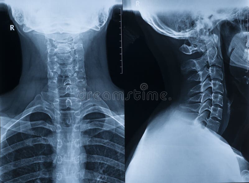 X-ray Picture of the Cervical Spine of a Man in Two Projections Stock ... X-ray Picture of the Cervical Spine of a Man in Two Projections Stock ...
