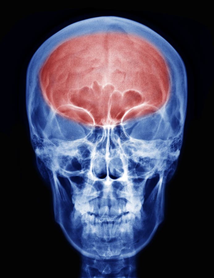 X-ray stock image. Image of human, test, traumatology - 31201881