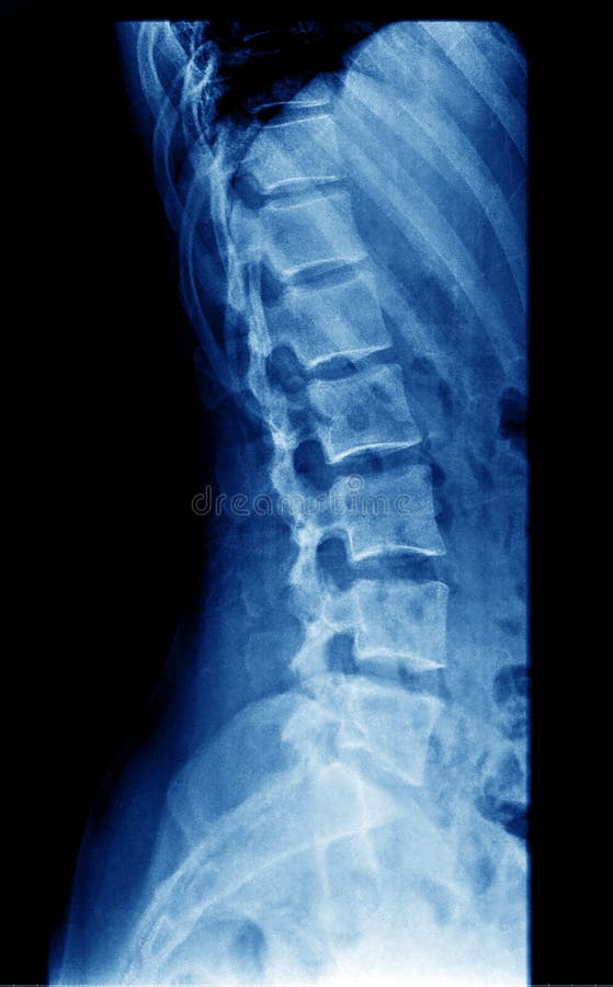 Film X-ray of Normal Human Pelvis and Hip Joints Stock Photo - Image of ...