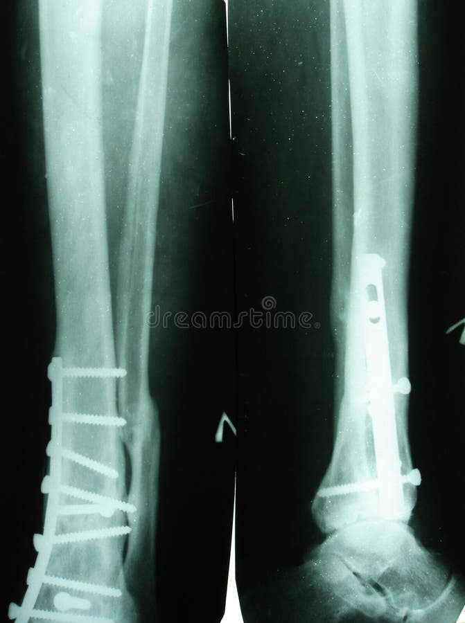 X-ray picture stock image. Image of details, anatomy - 10387257