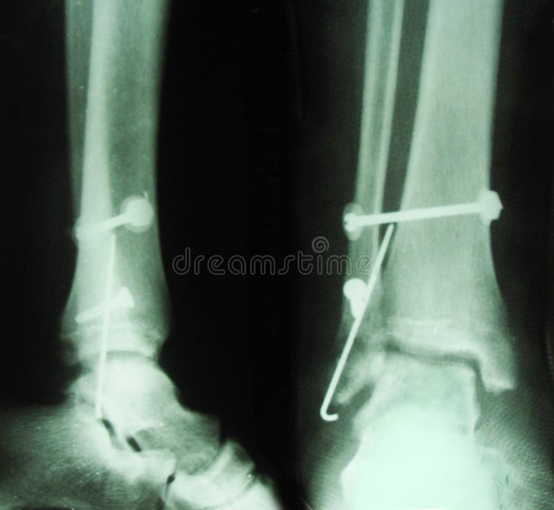 X-ray picture of human leg stock image. Image of medically - 983795