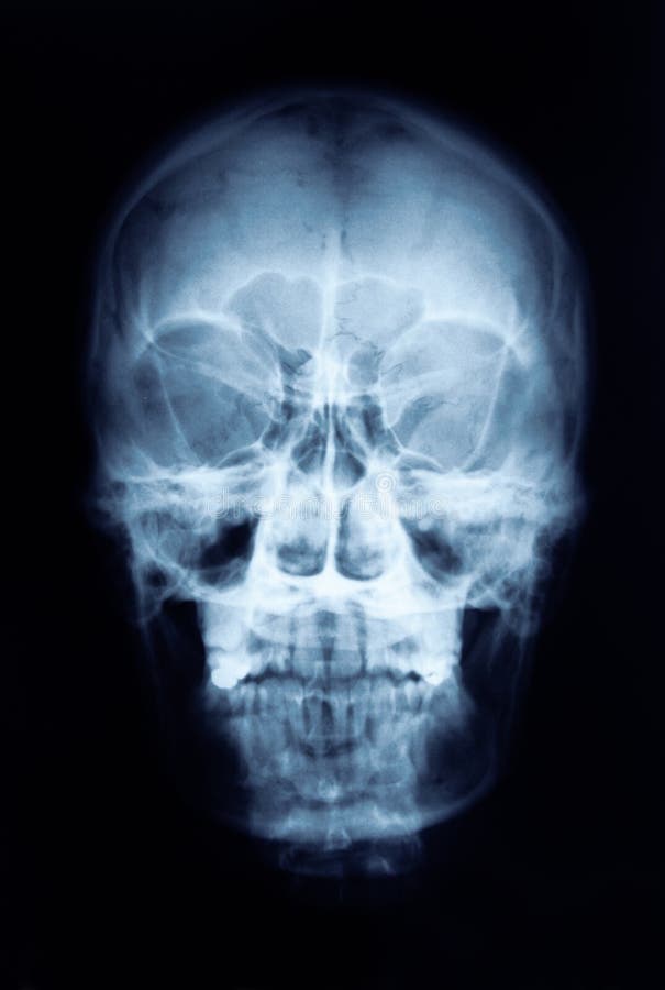 Film X-ray Skull AP : Show Normal Human S Skull Stock Photo - Image of ...