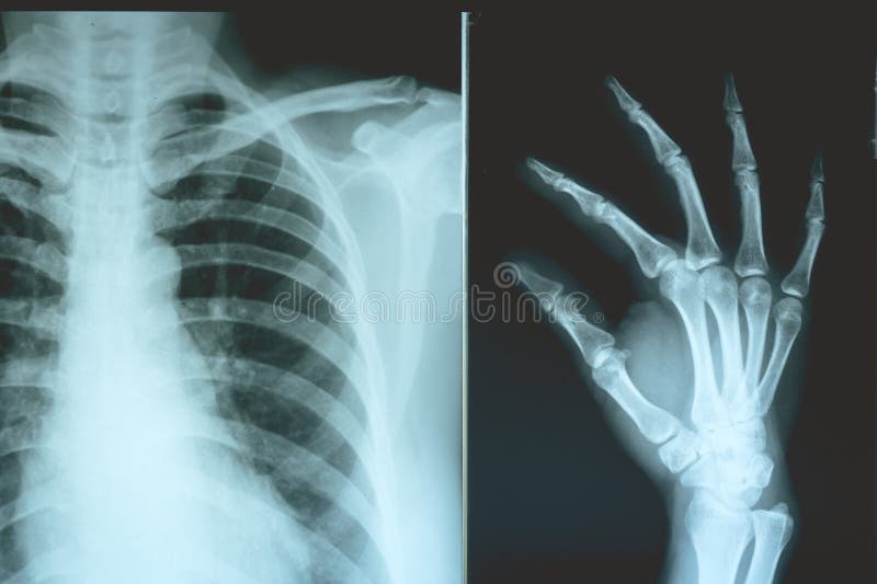 The X-ray Plates of the Ribs and Hands of a Patient. Conventional X-ray ...