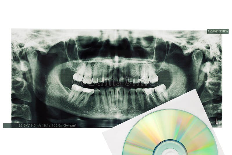 X-ray Printed Photo of Teeth and Digital Disk. Stock Image - Image of ...
