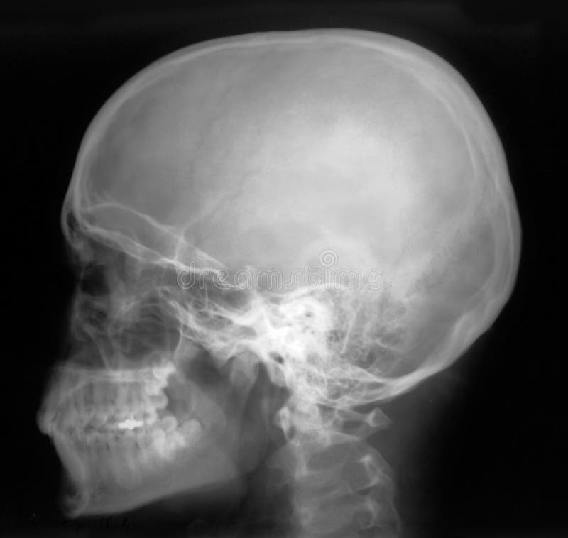 X-Ray Profile stock photo. Image of profile, anatomy, disease - 2087358