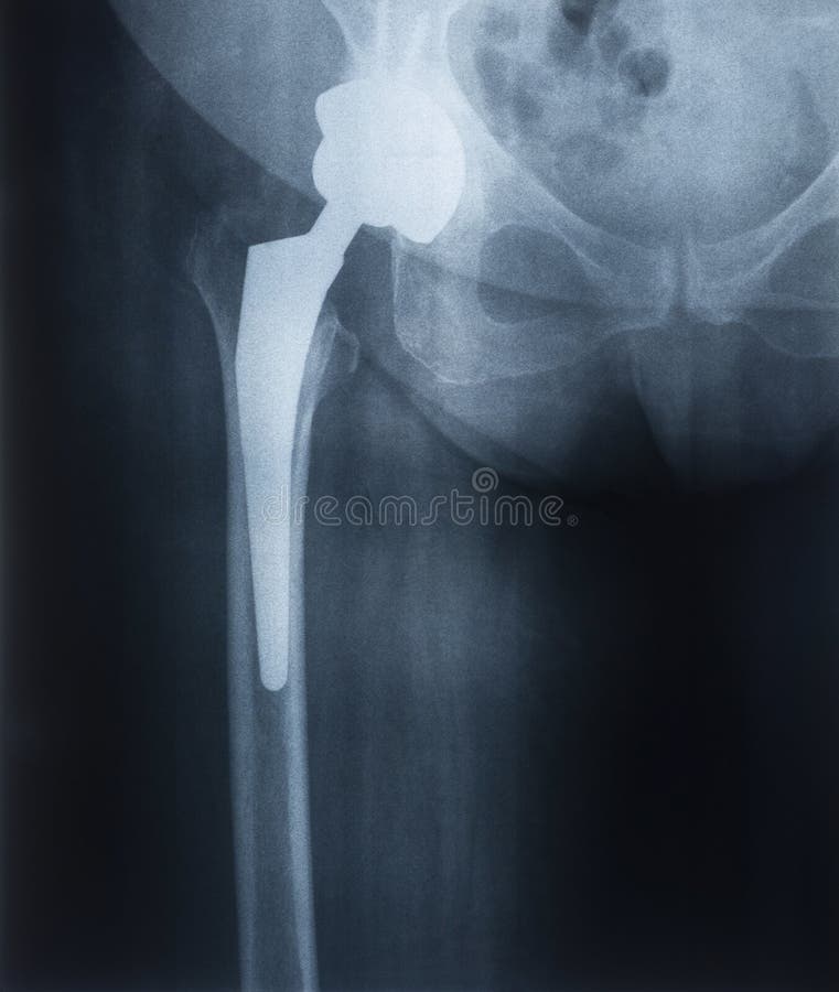 X-ray of a Prosthesis of a Female Hip Joint. Joint Endoprosthetics ...