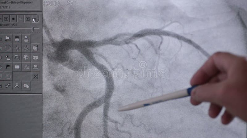 X-ray Real Heart Beating in Action. Stock Video - Video of medicine ...