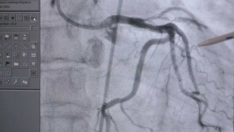 X-ray Real Heart Beating in Action on Computer Screen. Stock Video ...