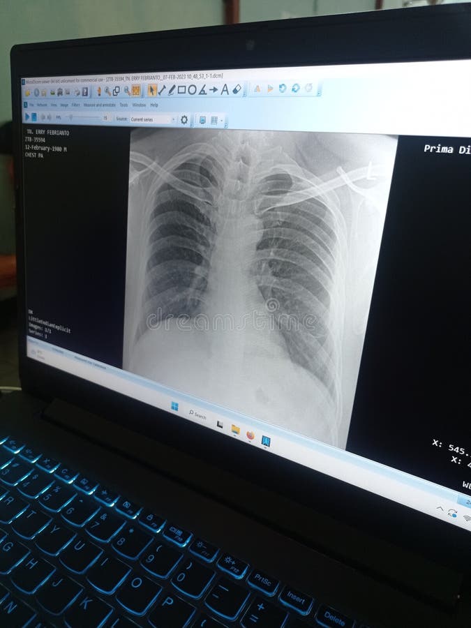 X-ray Results of the Lungs on a Laptop Screen Editorial Image - Image ...