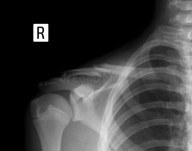 X-ray of the Right Collarbone. Fracture of Clavicle. Stock Photo ...