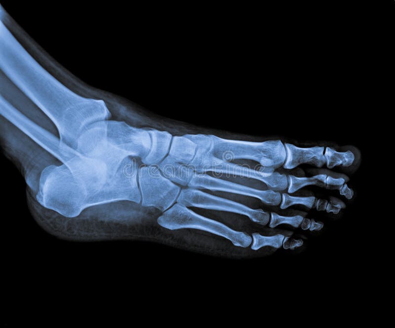 X Ray of Right Foot from Lateral Aspect. Stock Image - Image of ...
