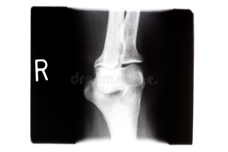 Rtg Broken Leg Stock Photos - Free & Royalty-Free Stock Photos from ...