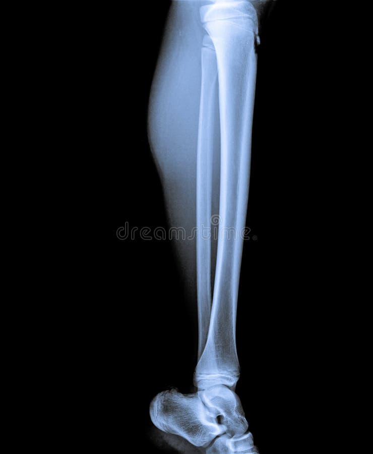 X ray ankle ap lateral stock photo. Image of fibula - 102024542