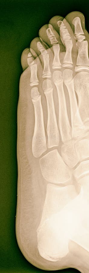 X-ray scan of human foot stock photo. Image of shape - 232366918