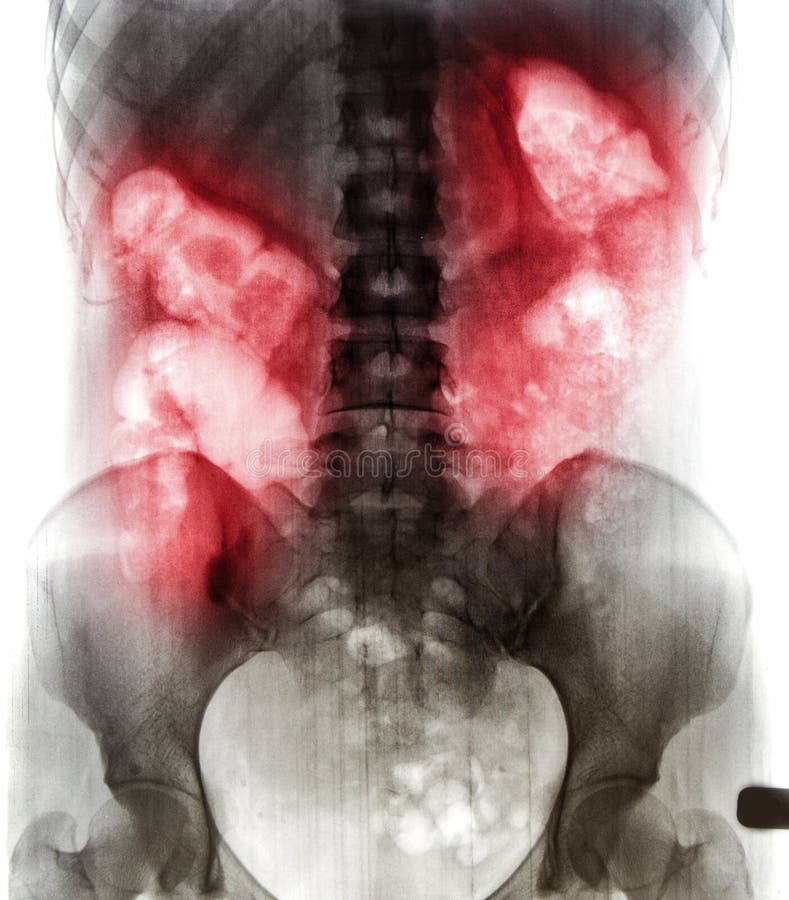 X-Ray scan human stock image. Image of hand, lung, sick - 44035813