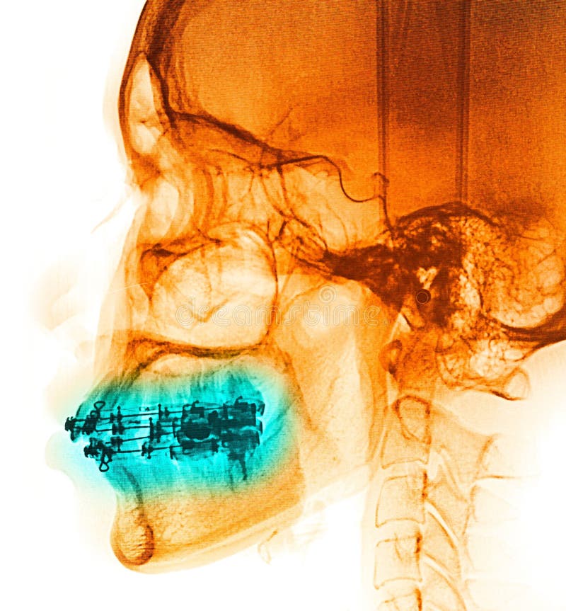 X-Ray scan human for teeth stock image. Image of body - 42767643