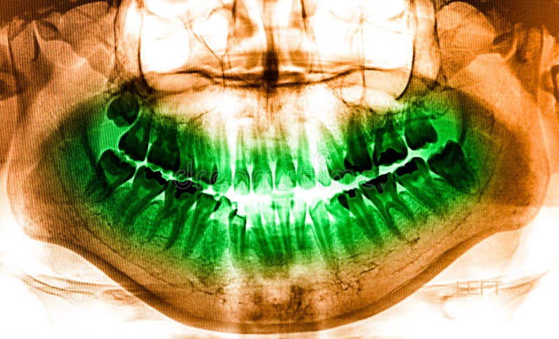 X-Ray scan human for teeth stock image. Image of brain - 42767645