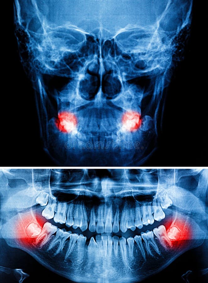 X-Ray scan human for teeth stock photo. Image of scan - 42767700
