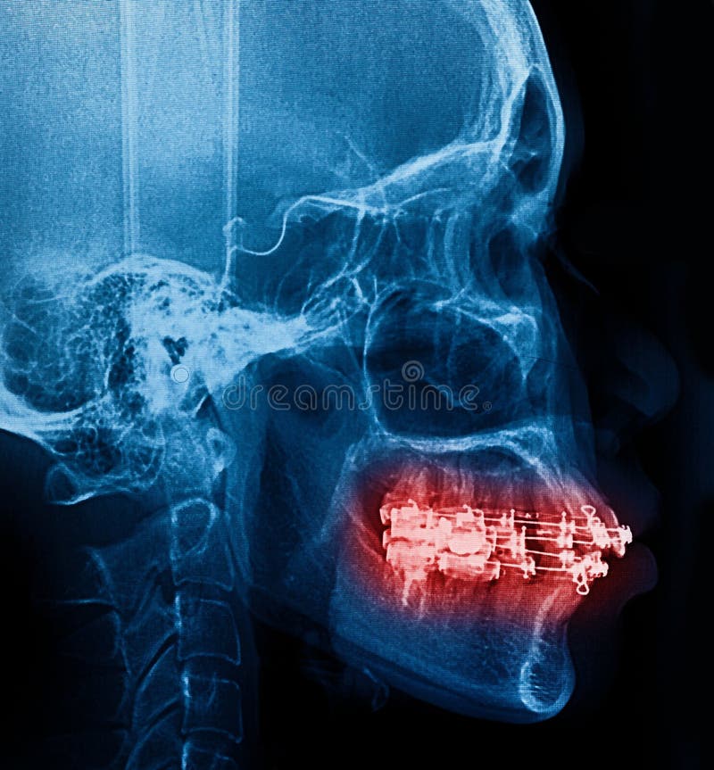 X-Ray scan human for teeth stock photo. Image of injury - 42767720
