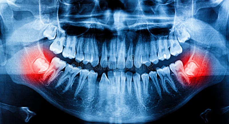 X-Ray scan human for teeth stock image. Image of hospital - 42767731