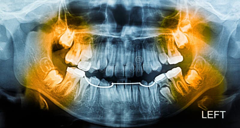 X-Ray scan human for teeth stock image. Image of stroke - 44034153