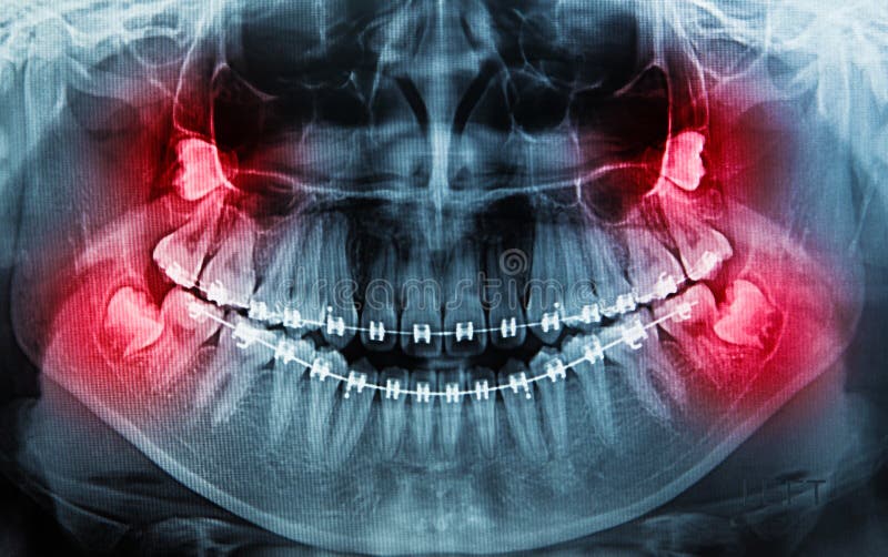X-Ray scan human for teeth stock photo. Image of arthritis - 44034228