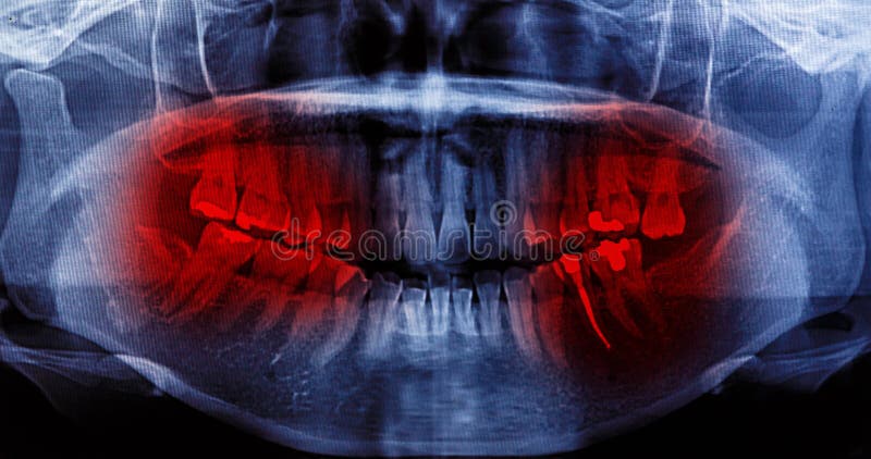 X-Ray scan human for teeth stock photo. Image of atomy - 51664764