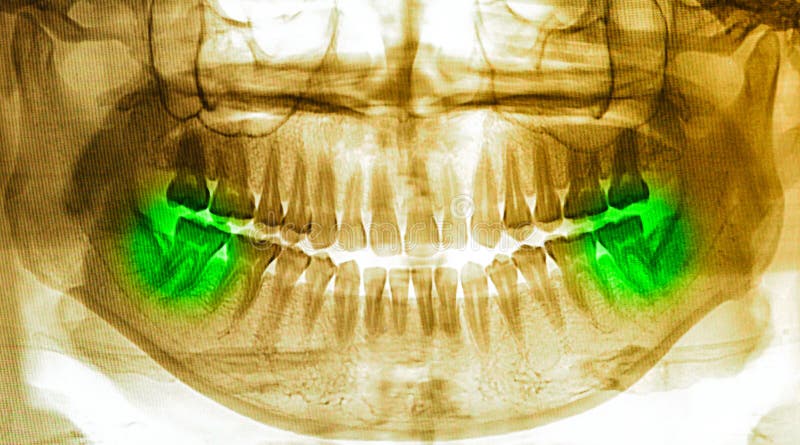X-Ray scan human for teeth stock image. Image of elbow - 51668643