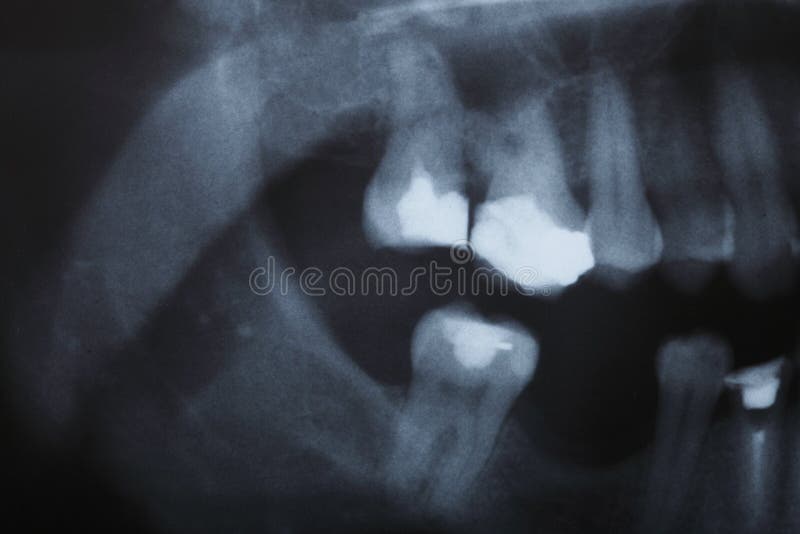 X-ray scan of humans teeth stock photo. Image of medicine - 31277162
