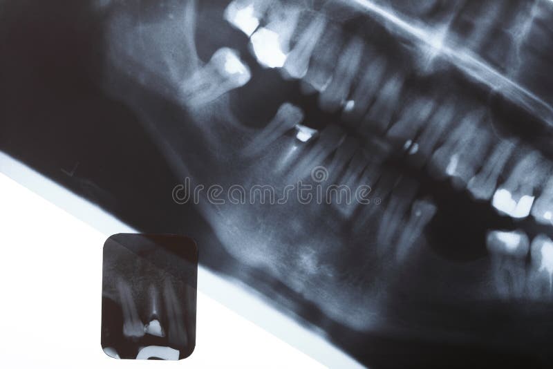 X-ray scan of humans teeth stock photo. Image of black - 41228726