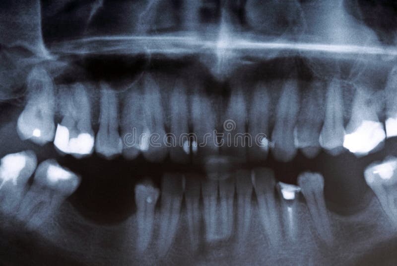X-ray scan of humans teeth stock image. Image of anatomy - 30894909