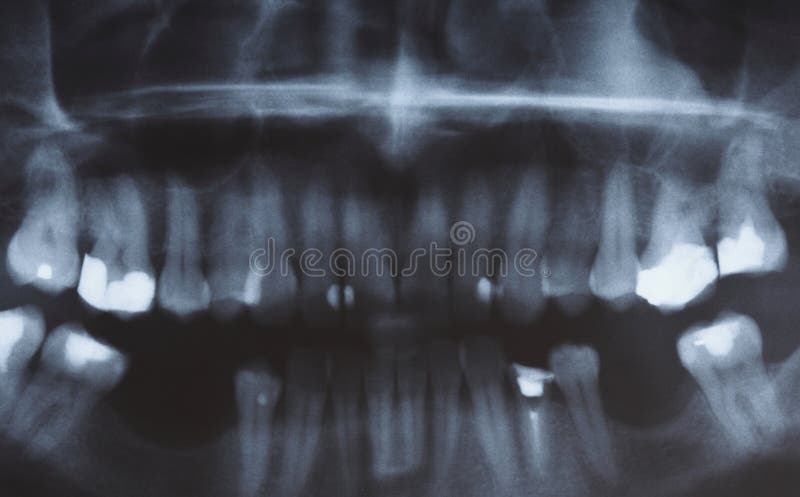 X-ray scan of humans teeth stock photo. Image of bone - 33009436
