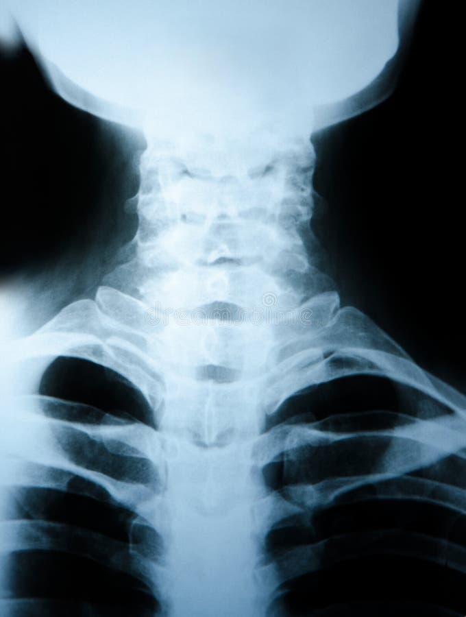 X-ray scan of neck stock photo. Image of patient, film - 29692200