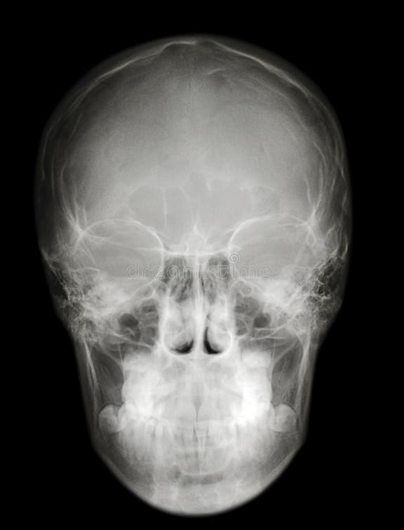 X-ray scull front profile stock image. Image of bone - 12676023