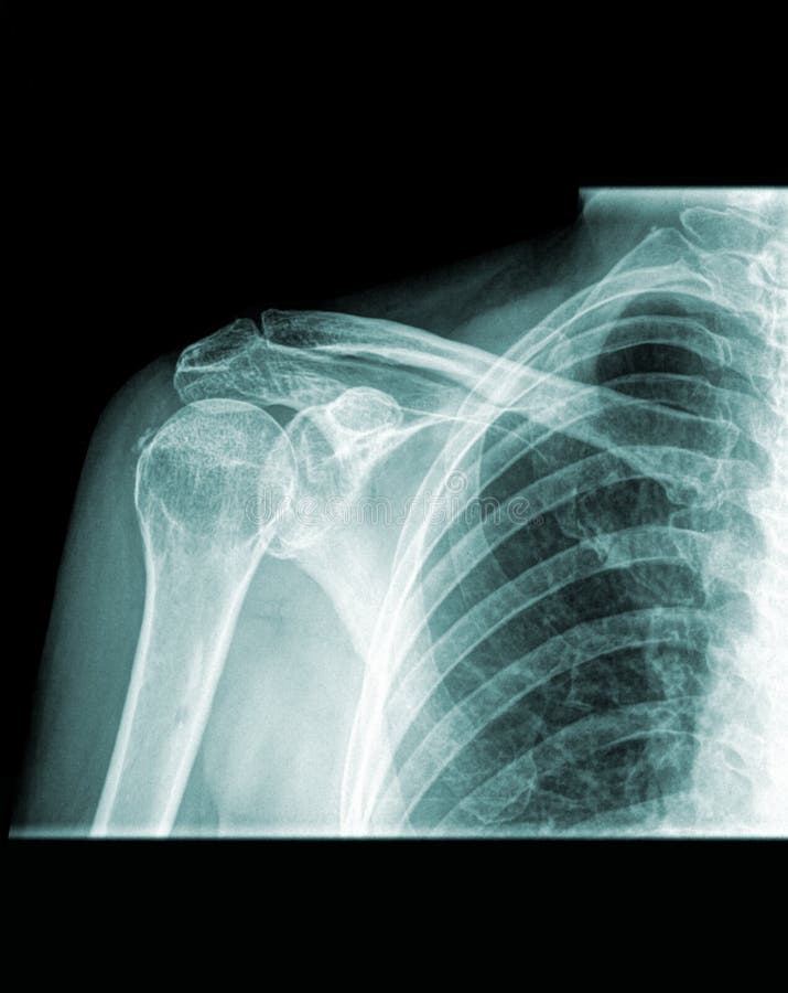 X-ray of a shoulder stock photo. Image of bone, skeleton - 12910504