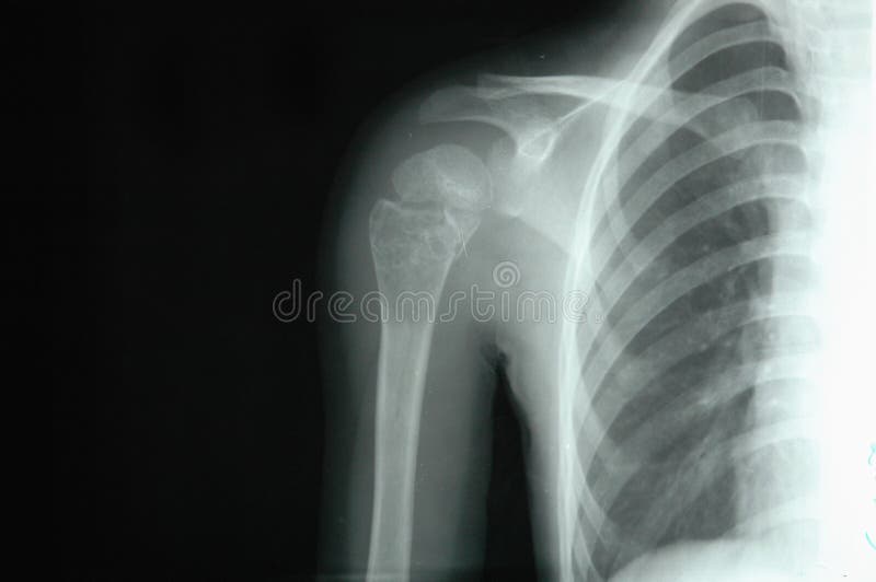 X-ray shoulder stock photo. Image of anatomy, trauma, bones - 8885580