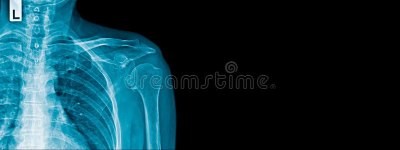 X-ray Shoulder Banner Design in Blue Stock Image - Image of disease ...