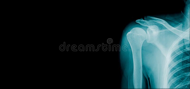 X-ray Shoulder Banner Design in Blue Stock Image - Image of disease ...